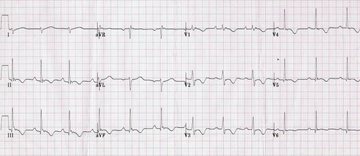 Ventricular Tachycardia due to Arrhythmogenic Right Ventricular ...