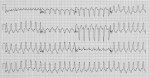 Ventricular Tachycardia due to Arrhythmogenic Right Ventricular ...