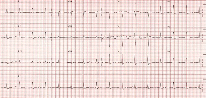 Tricyclic Antidepressant Overdose – EM Sim Cases