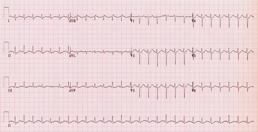 Intra-abdominal Sepsis – EM Sim Cases