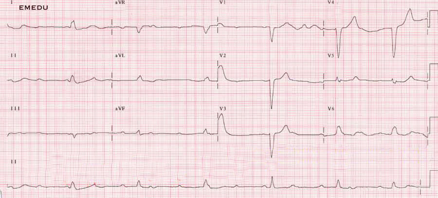 Unstable Bradycardia – EM Sim Cases