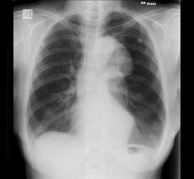 Aortic Dissection – EM Sim Cases