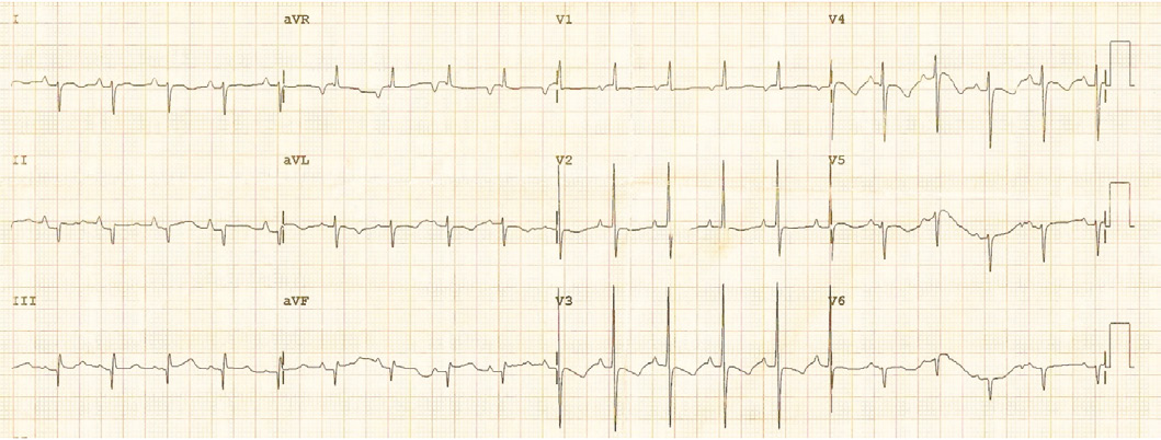 Coarctation of the Aorta – EM Sim Cases