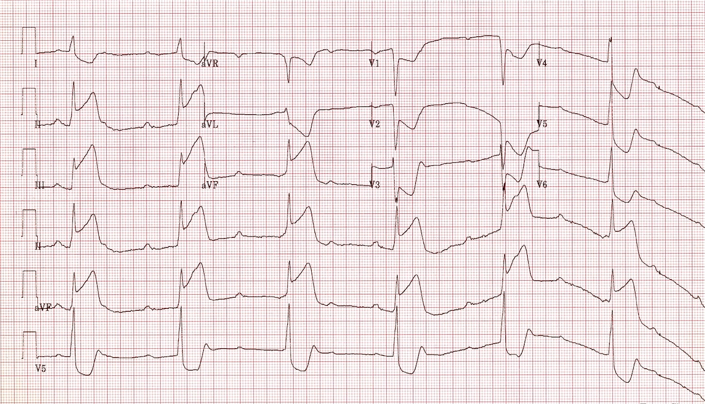 Inferior Stemi A MASQUERADING ECG: LACOSAMIDE ASSOCIATED ECG CHANGES