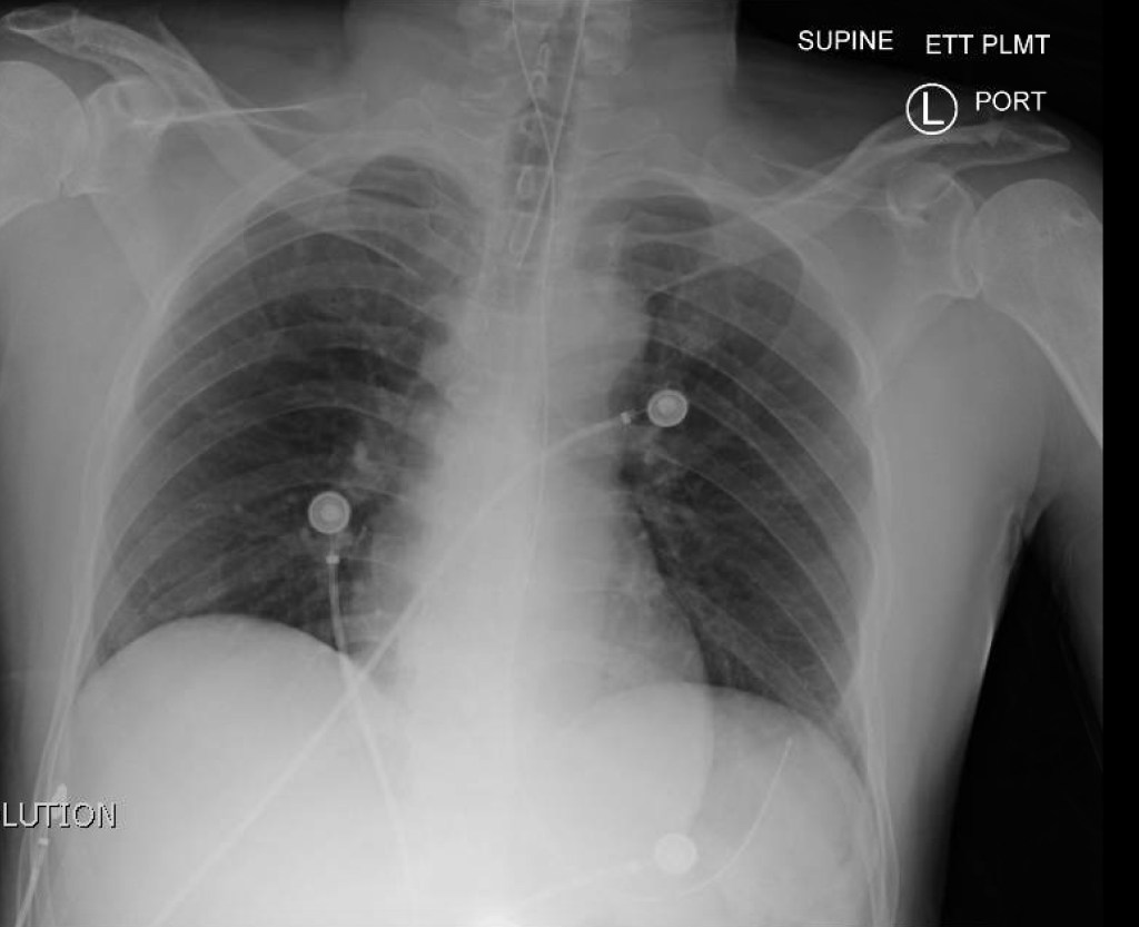 Anaphylaxis (+/- Laryngospasm) – EM Sim Cases