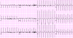 Pediatric SVT – EM Sim Cases