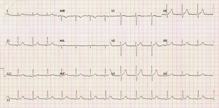 Pediatric SVT – EM Sim Cases