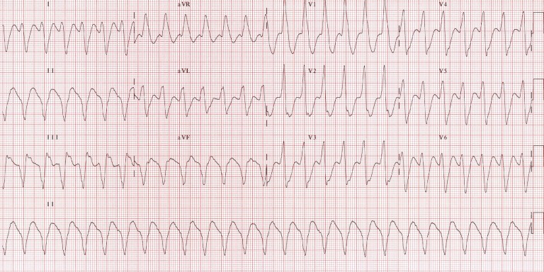 Pediatric SVT – EM Sim Cases