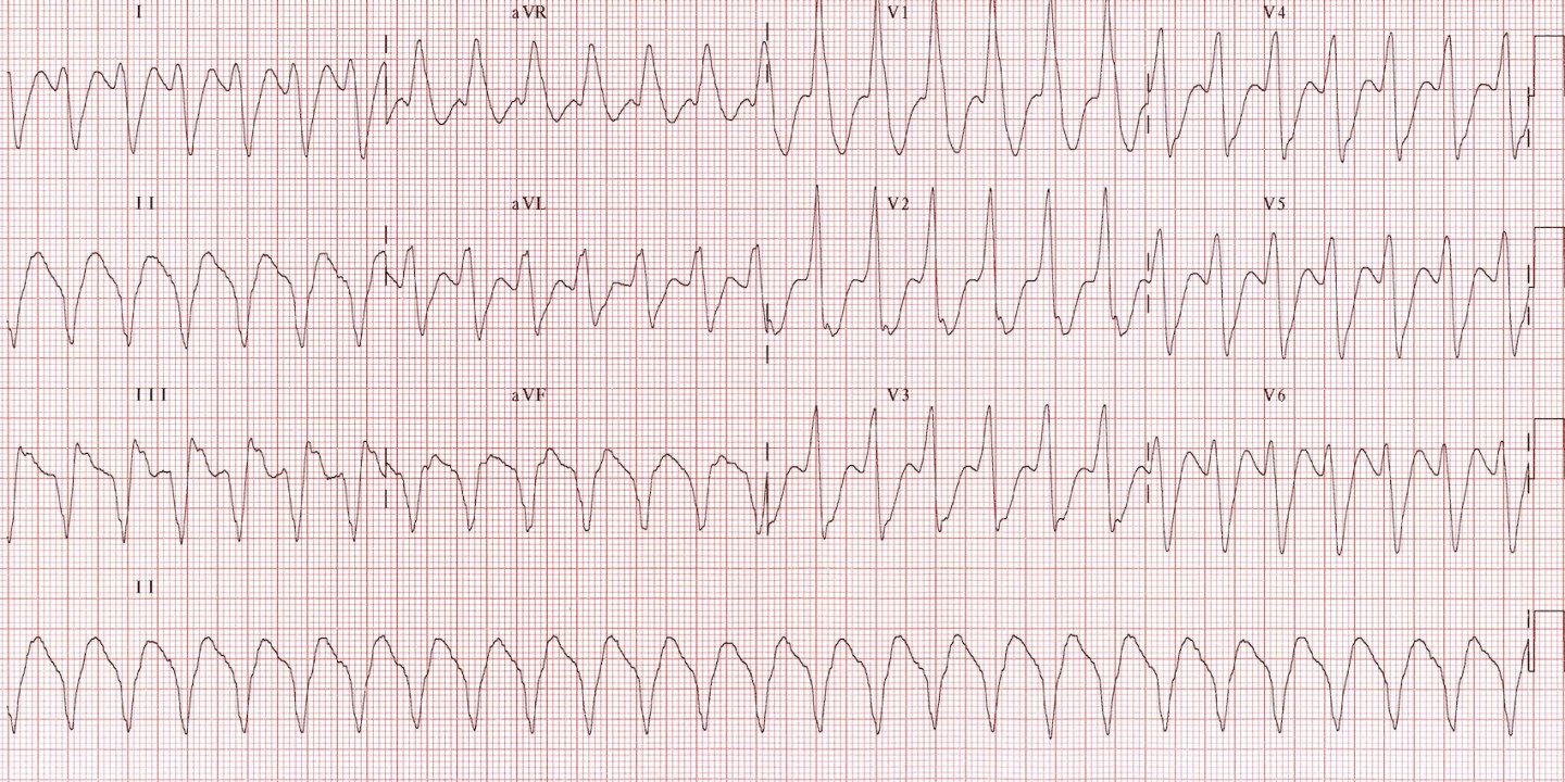 Pediatric SVT – EM Sim Cases