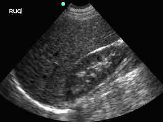 Pregnant Cardiomyopathy – EM Sim Cases