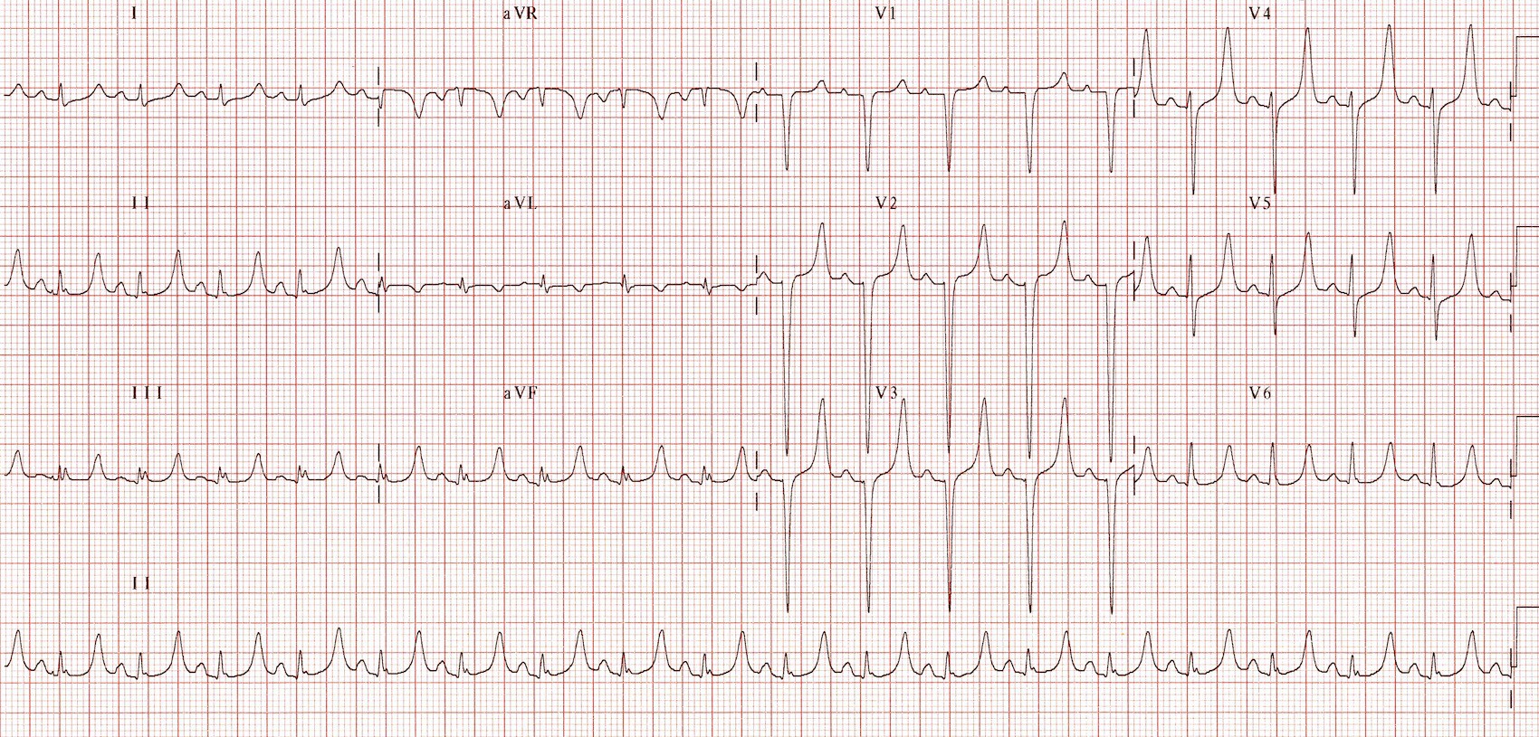 LVAD Case – EM Sim Cases
