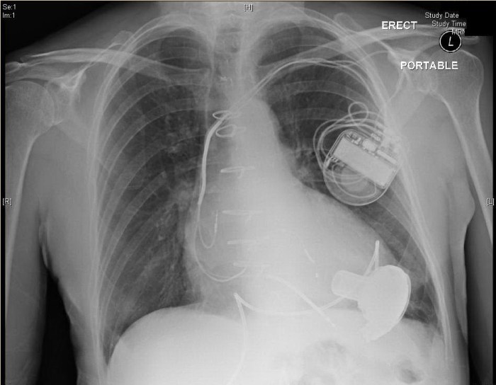 LVAD Case – EM Sim Cases