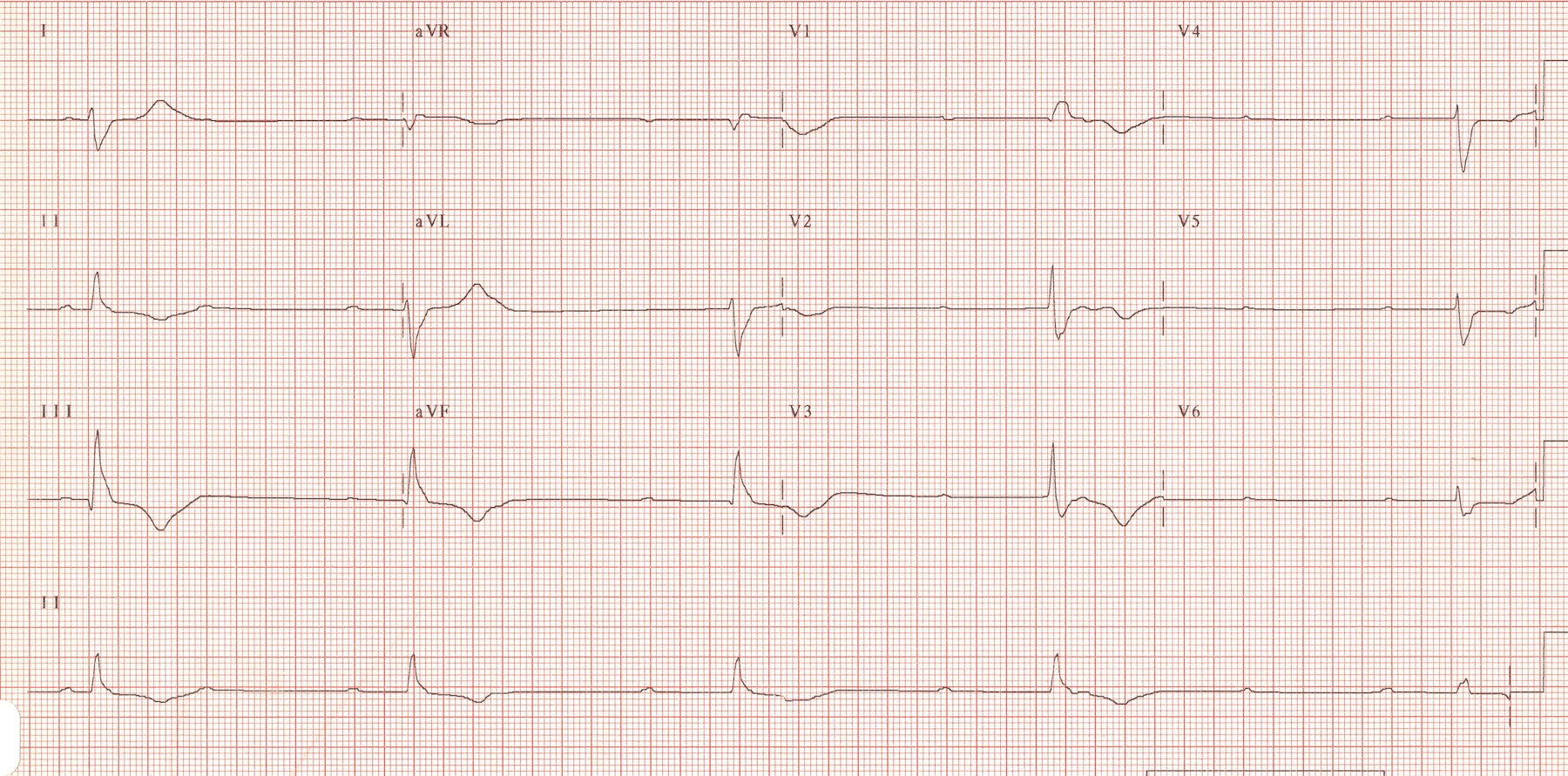 Nightmares Case 1: Bradycardia – EM Sim Cases