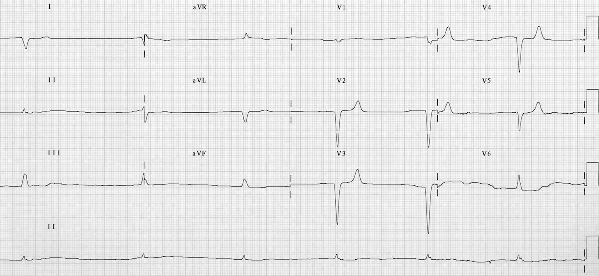 Nightmares Case 7: Hyperkalemia – EM Sim Cases