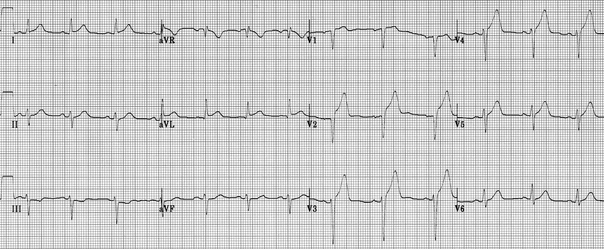 COVID-19: STEMI with VF Arrest – EM Sim Cases