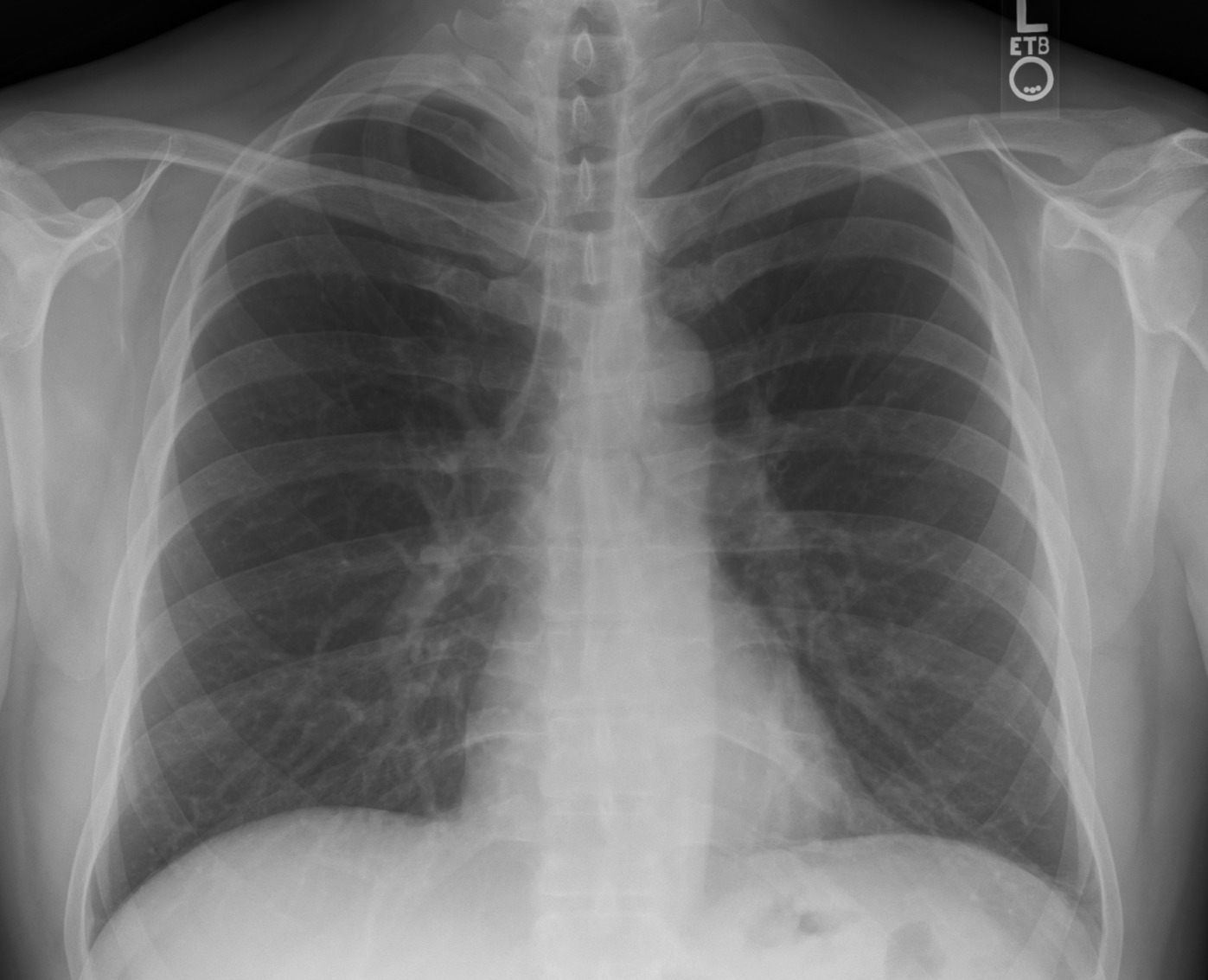 Unstable Atrial Fib – EM Sim Cases