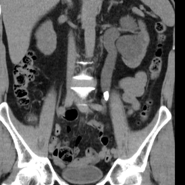 Urologic Sepsis – EM Sim Cases