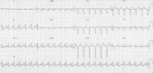 COPDE with Pneumothorax – EM Sim Cases