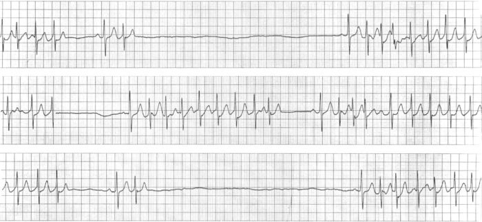 Atrial Fibrillation – EM Sim Cases
